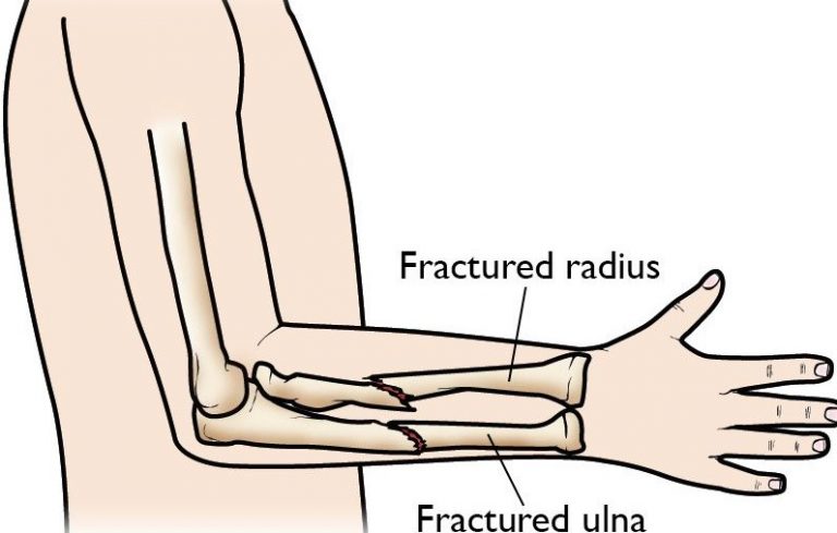 Fraturas do antebraço – Dr. Wilson Lino Jr.
